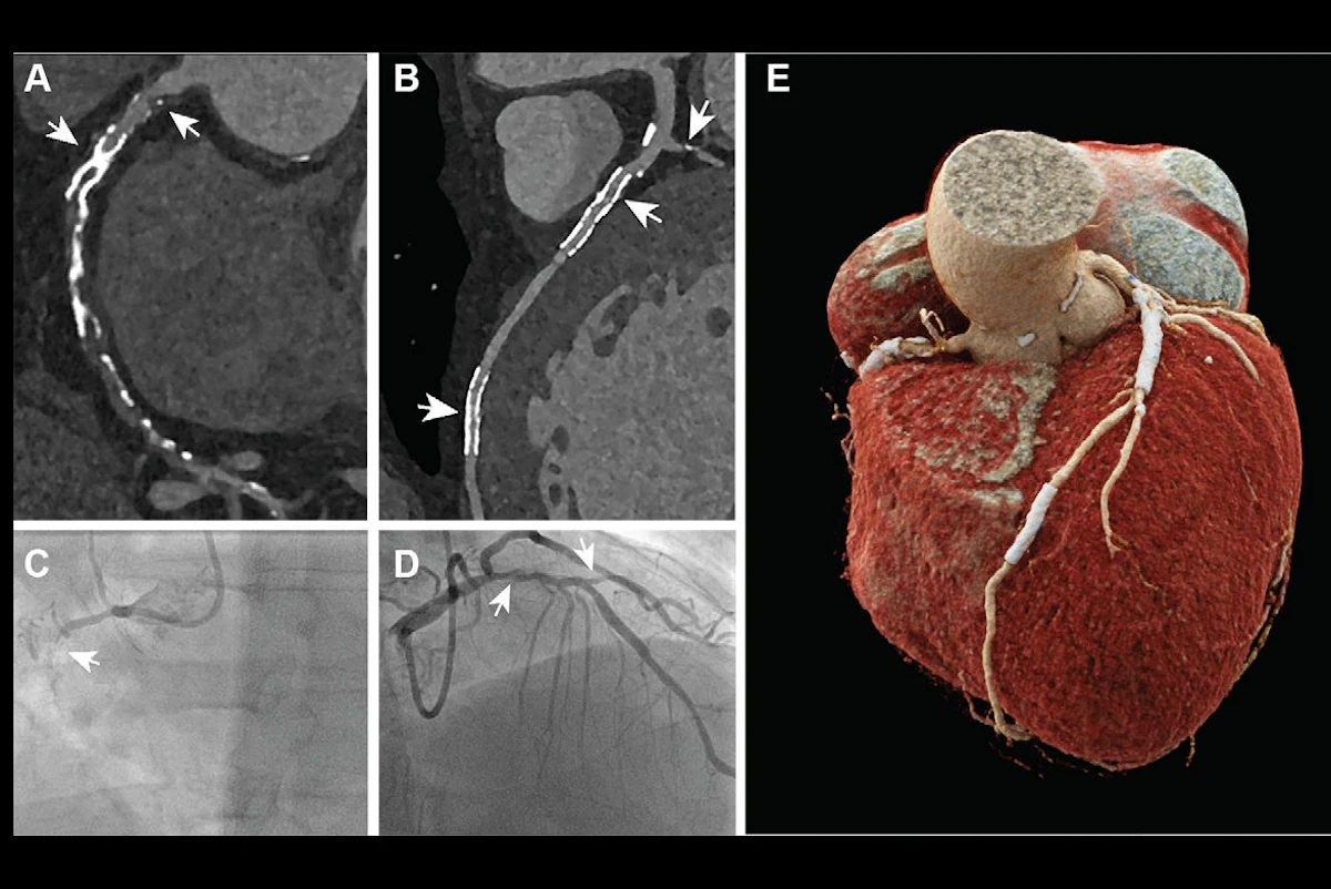 PCCT boosts diagnostic accuracy for coronary stent assessment | AuntMinnie