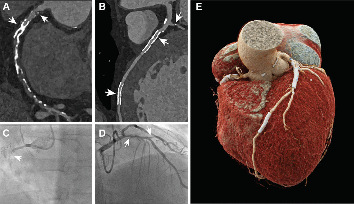 PCCT boosts diagnostic accuracy for coronary stent assessment | AuntMinnie