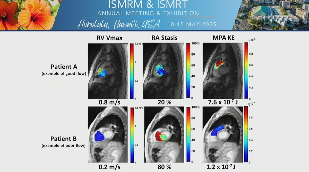 ISMRM: 4D MRI reveals heart impairments in patients with COPD | AuntMinnie