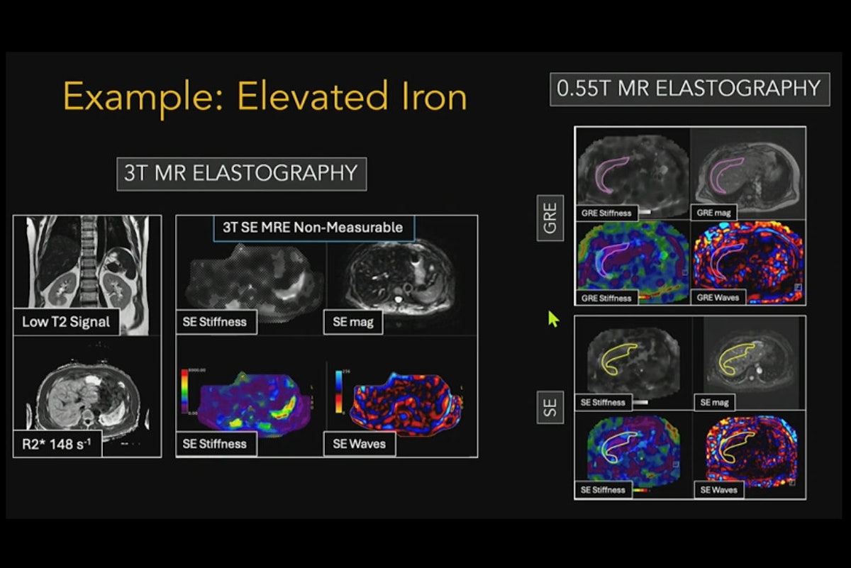 ISMRM: Low-field MR elastography feasible in liver imaging | AuntMinnie