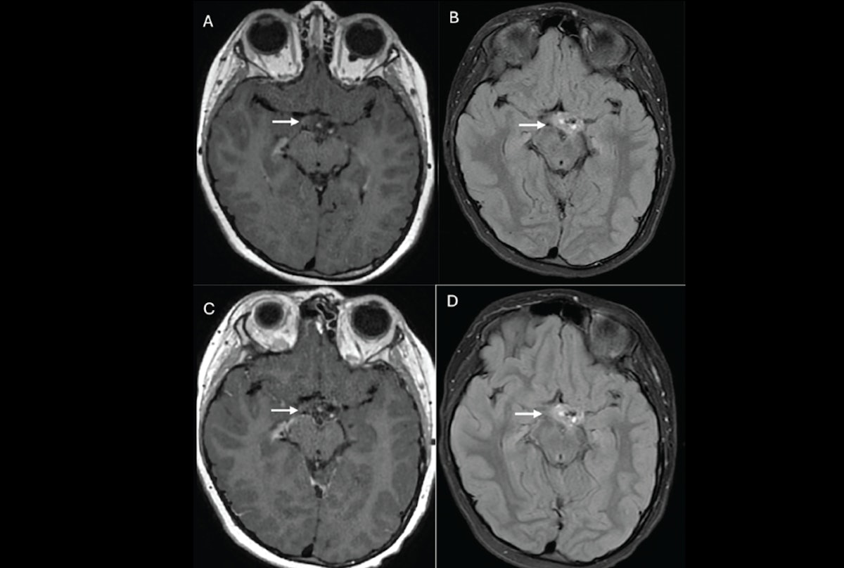 Gadopiclenol at half GBCA dose effective for pediatric brain MRI ...