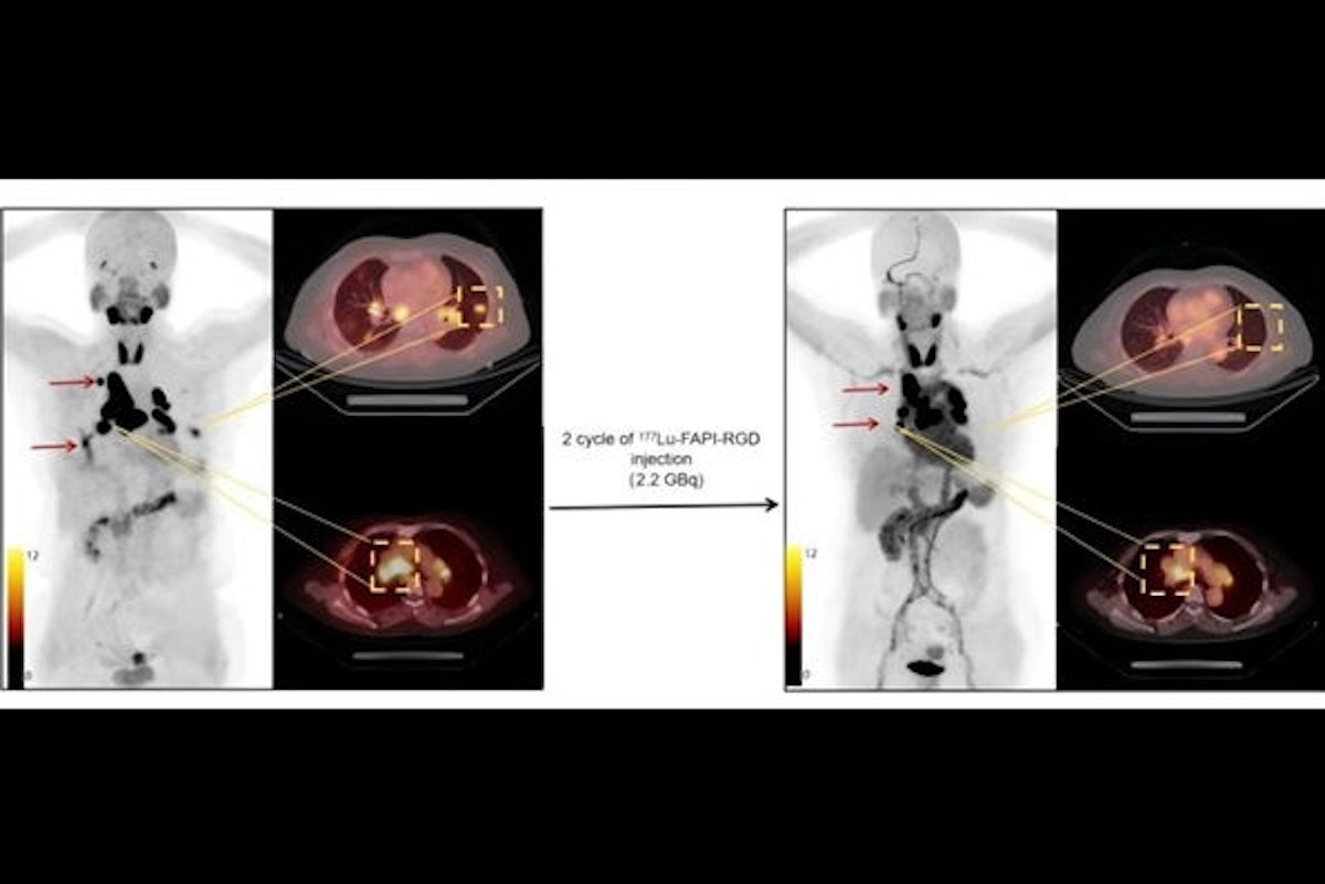 SNMMI: Dual-targeting radioligand therapy safe for several cancers ...