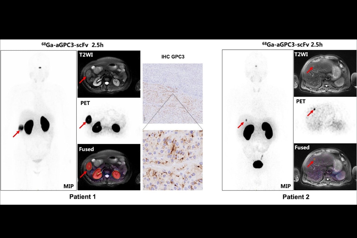 SNMMI: New molecular imaging agent shows promise for detecting HCC ...