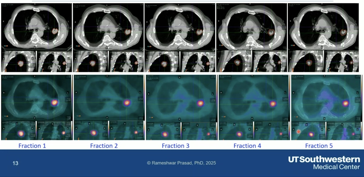 SNMMI: Novel adaptive radiotherapy system improves tumor response ...