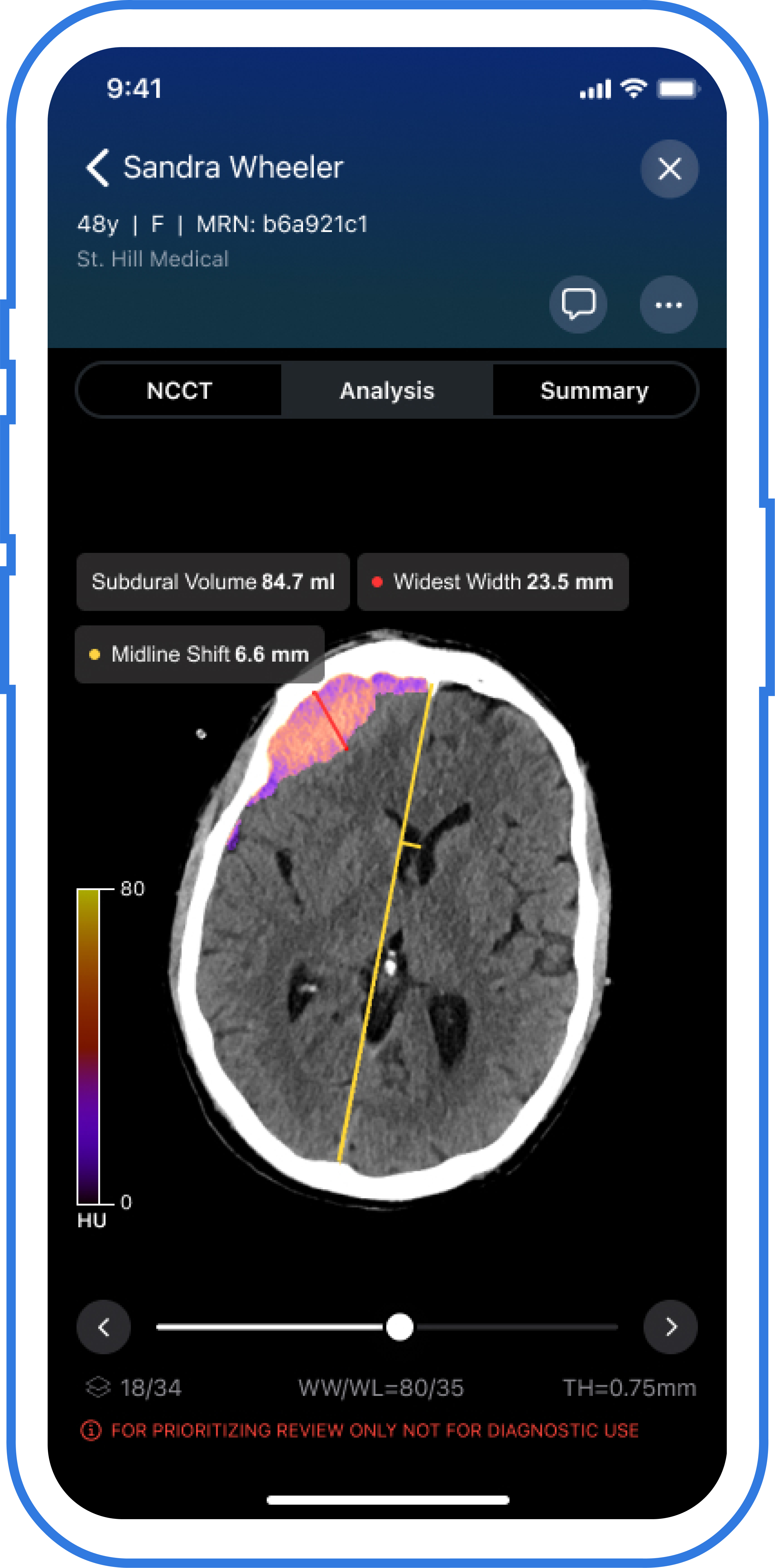 Viz.ai gets FDA nod for Viz Subdural Plus | AuntMinnie