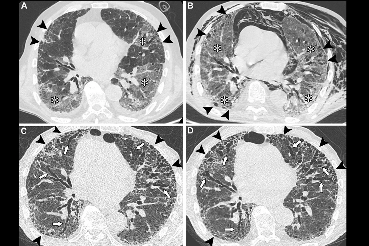Thoracic radiologists publish post-COVID CT imaging recommendations ...