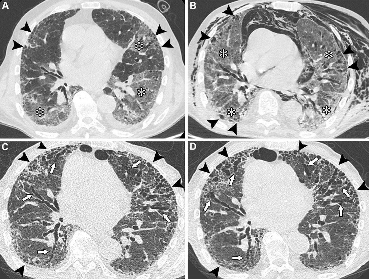 lingula lung ct