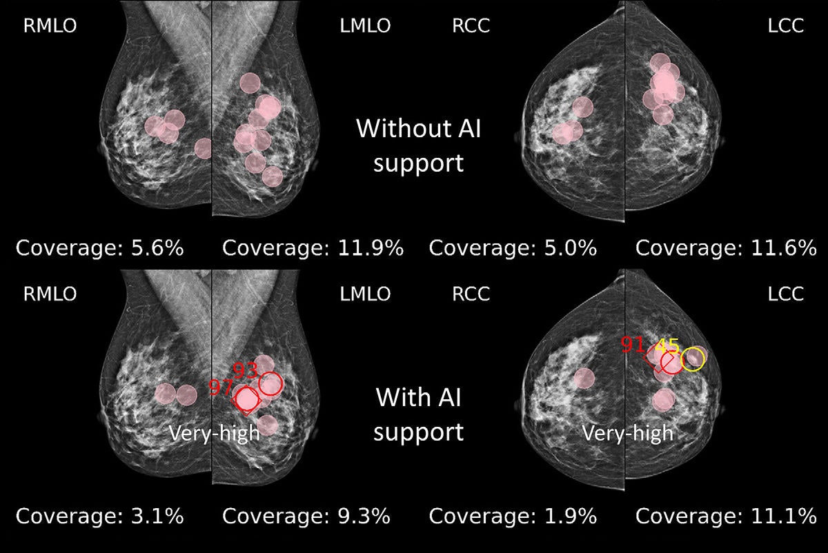AI helps radiologists focus on lesions more than entire breast on mammo ...