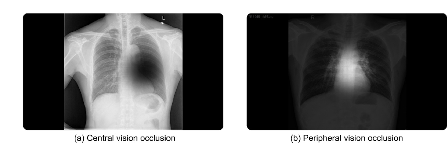 Peripheral vision training improves lesion detection | AuntMinnie