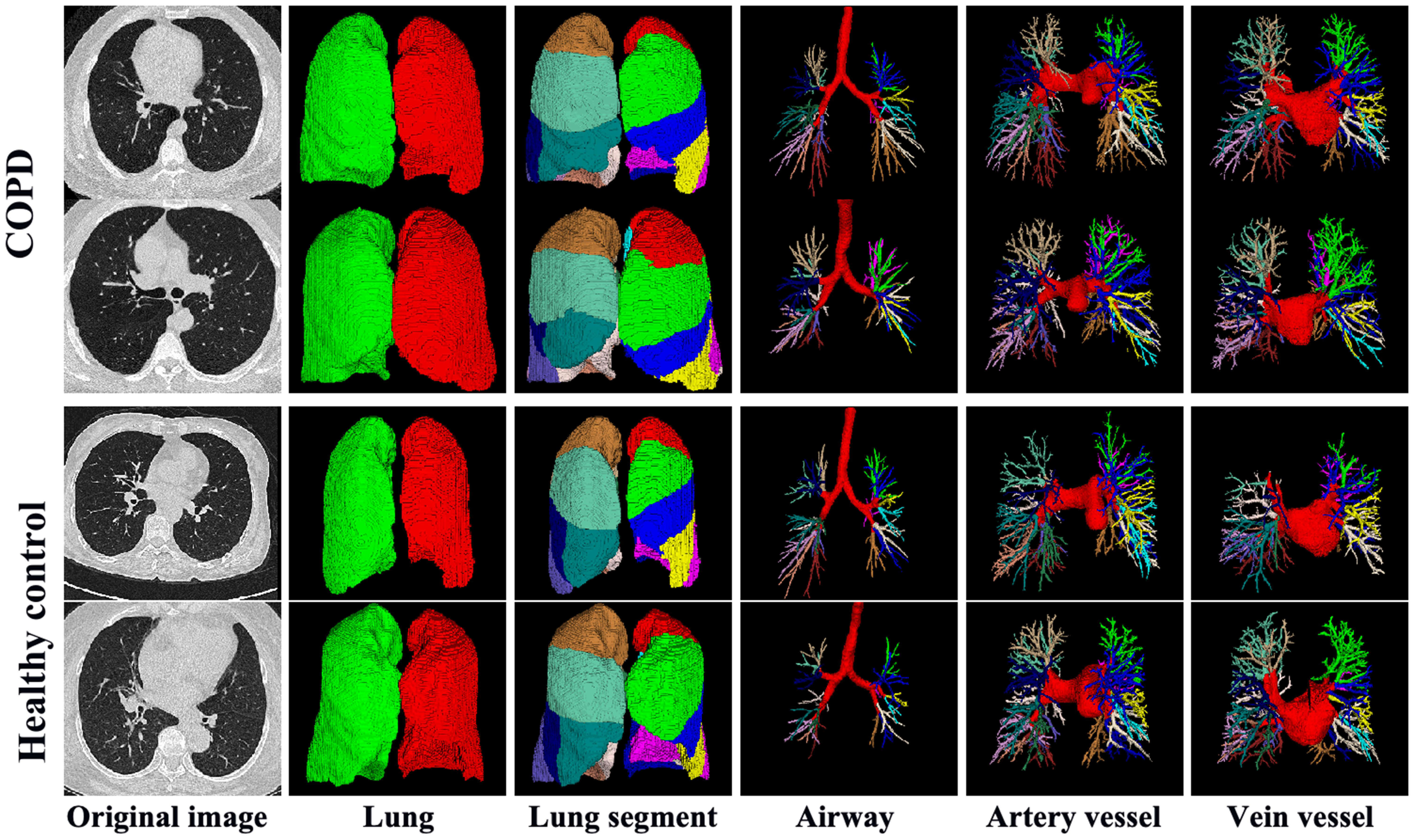 Machine learning plus CT helps assess severity of COPD | AuntMinnie