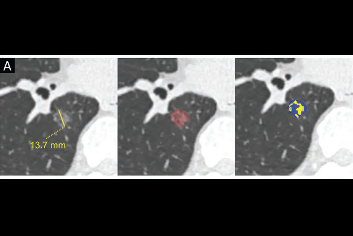 'Habitat' AI model helps stratify lung nodule disease risk on LDCT ...