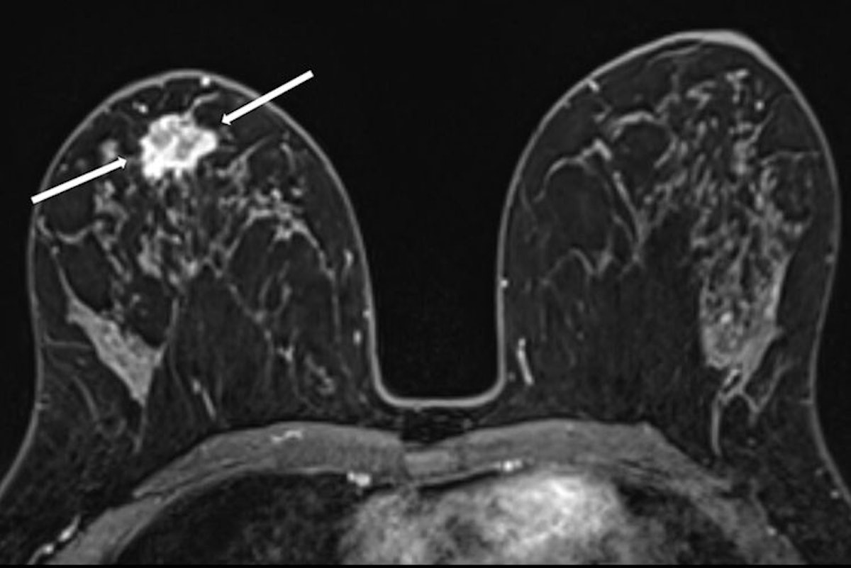 Node-RADS evaluates breast cancers on MRI exams | AuntMinnie