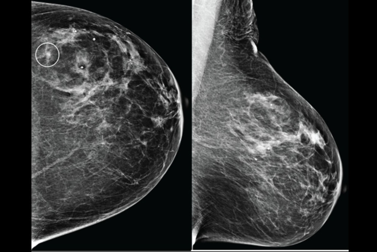 AI interpretation leads to high NPV, recall rates in breast imaging ...