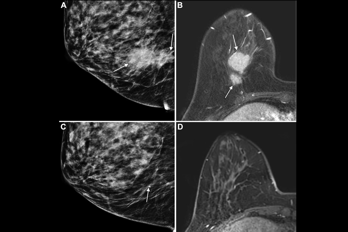 Breast calcifications affect MRI cancer treatment response prediction ...