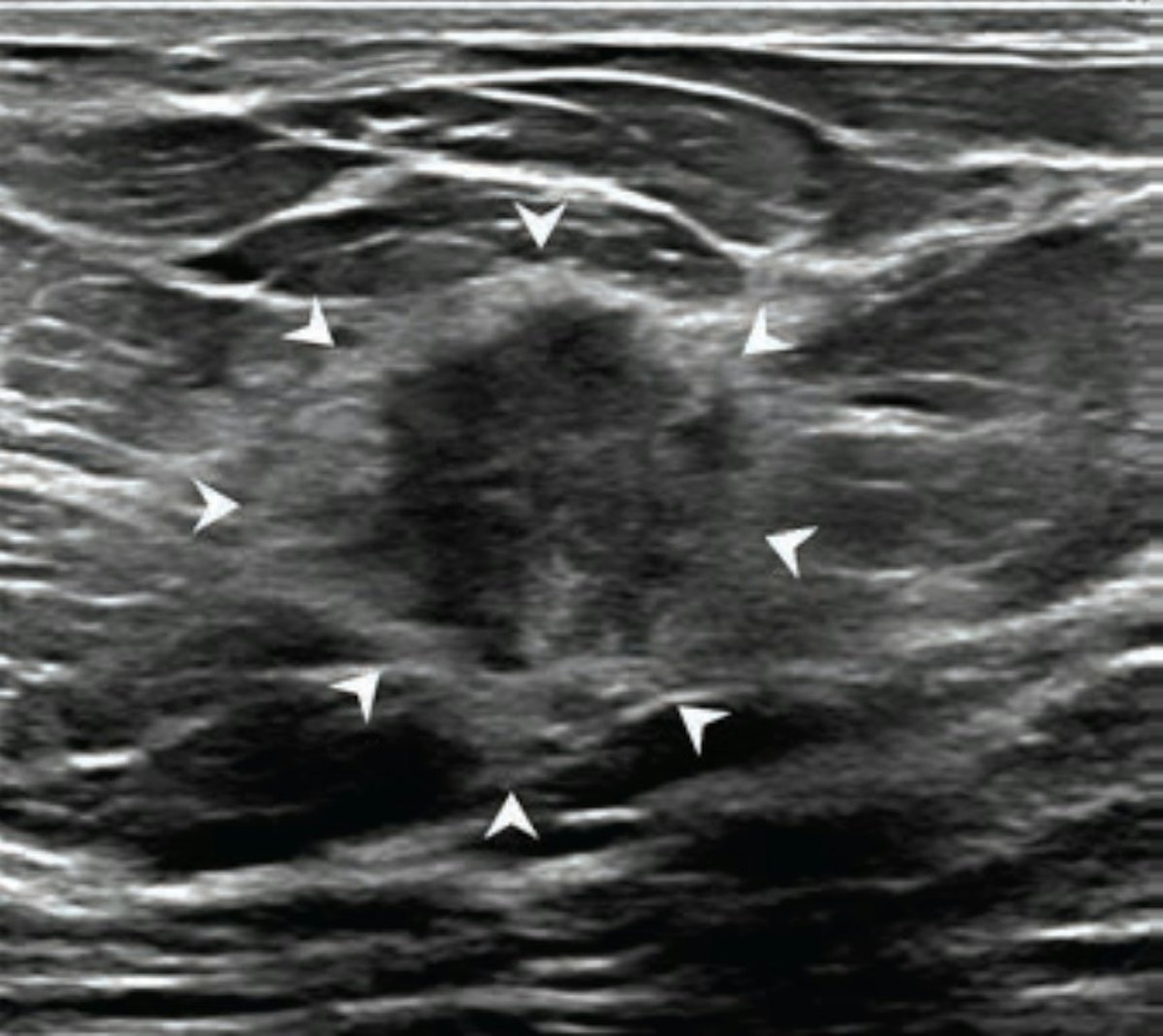 Echogenic rind on breast ultrasound holds diagnostic significance ...