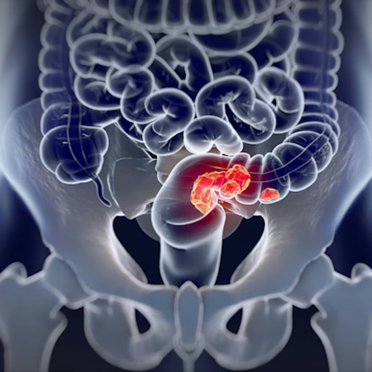 PET/MRI shows promise in rectal cancer | AuntMinnie