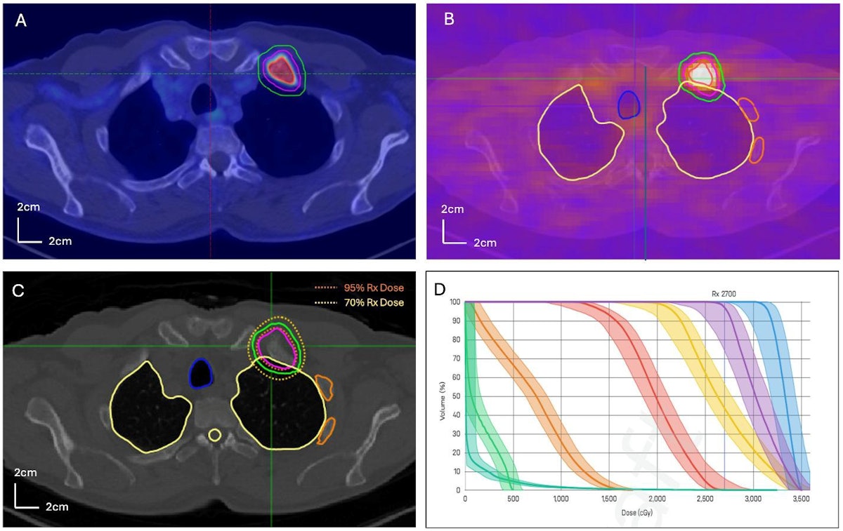 Radiation oncologists put RefleXion’s X1 system to the test | AuntMinnie