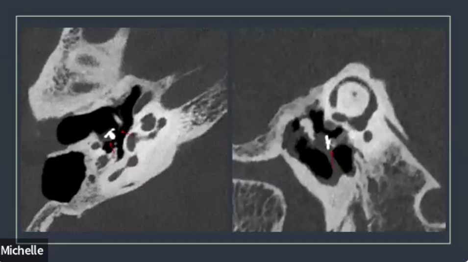 ISCT: Mayo Clinic expert outlines how best to allocate PCCT resources ...