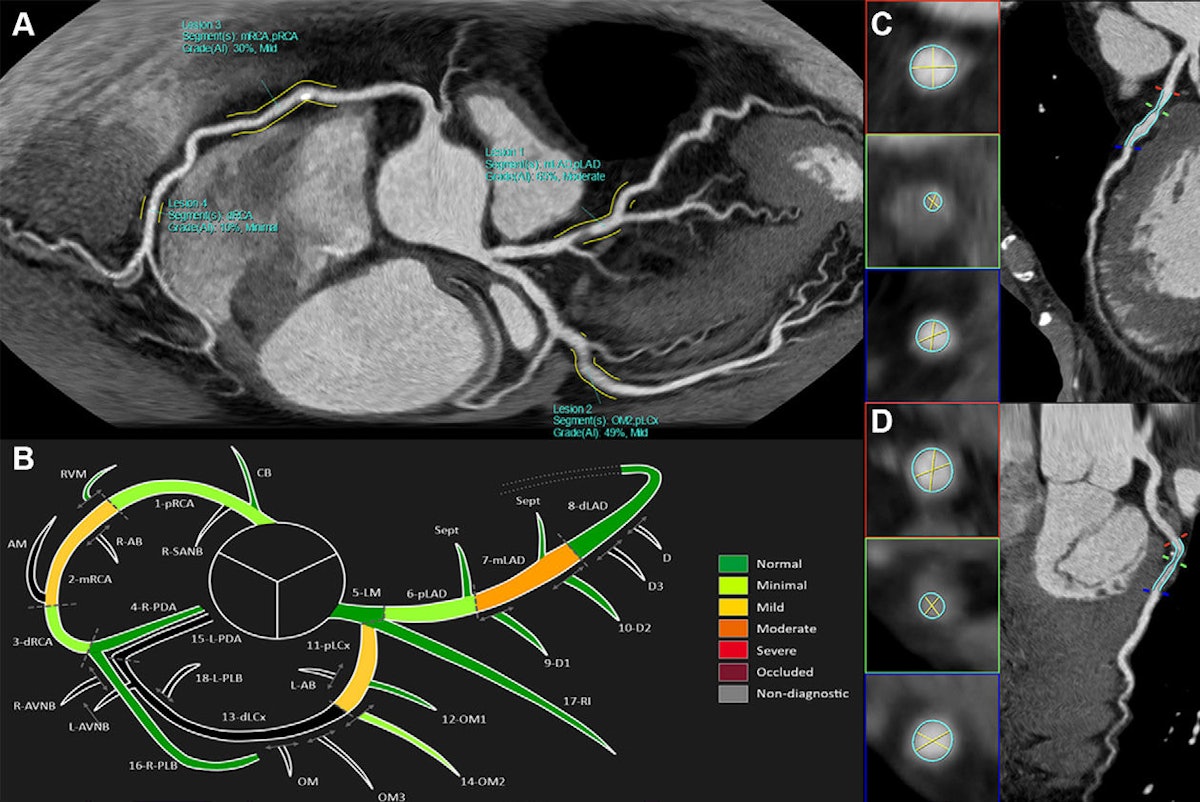 AI improves interreader CAD-RADS agreement on CCTA | AuntMinnie