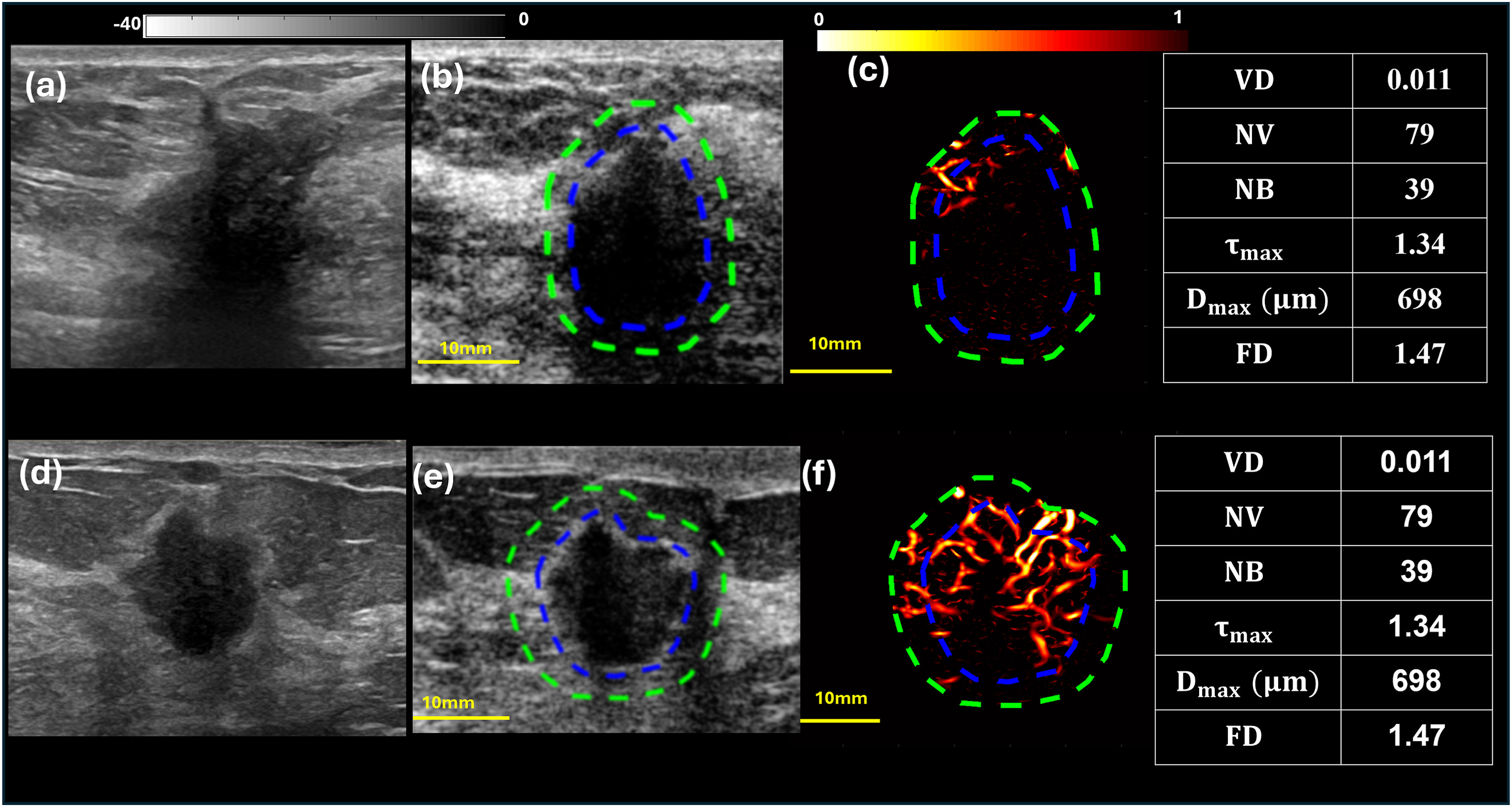 qHDMI differentiates radial scars from invasive breast cancer | AuntMinnie