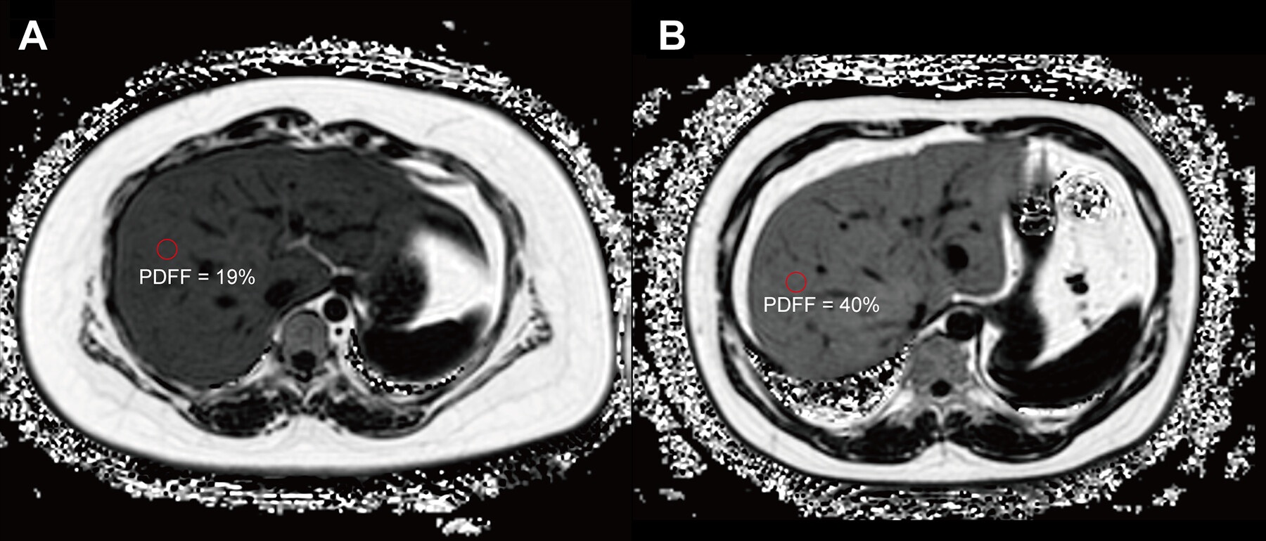 MRI predicts diabetes in obese patients | AuntMinnie