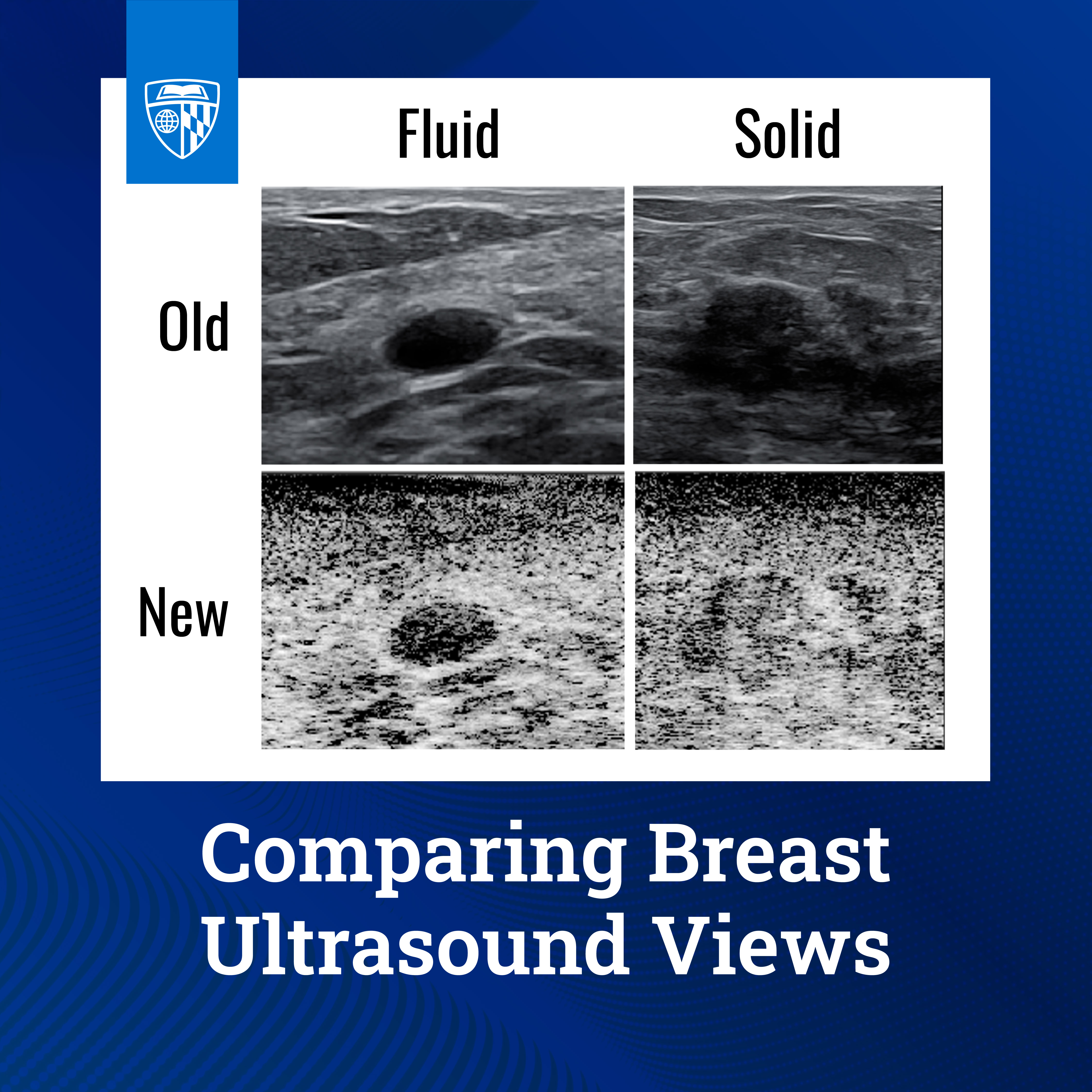 New breast ultrasound approach cuts false positives by nearly a third ...
