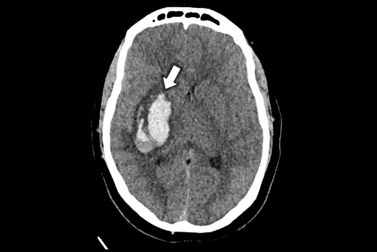 Key neurologic imaging patterns of recreational drug use in the ED ...