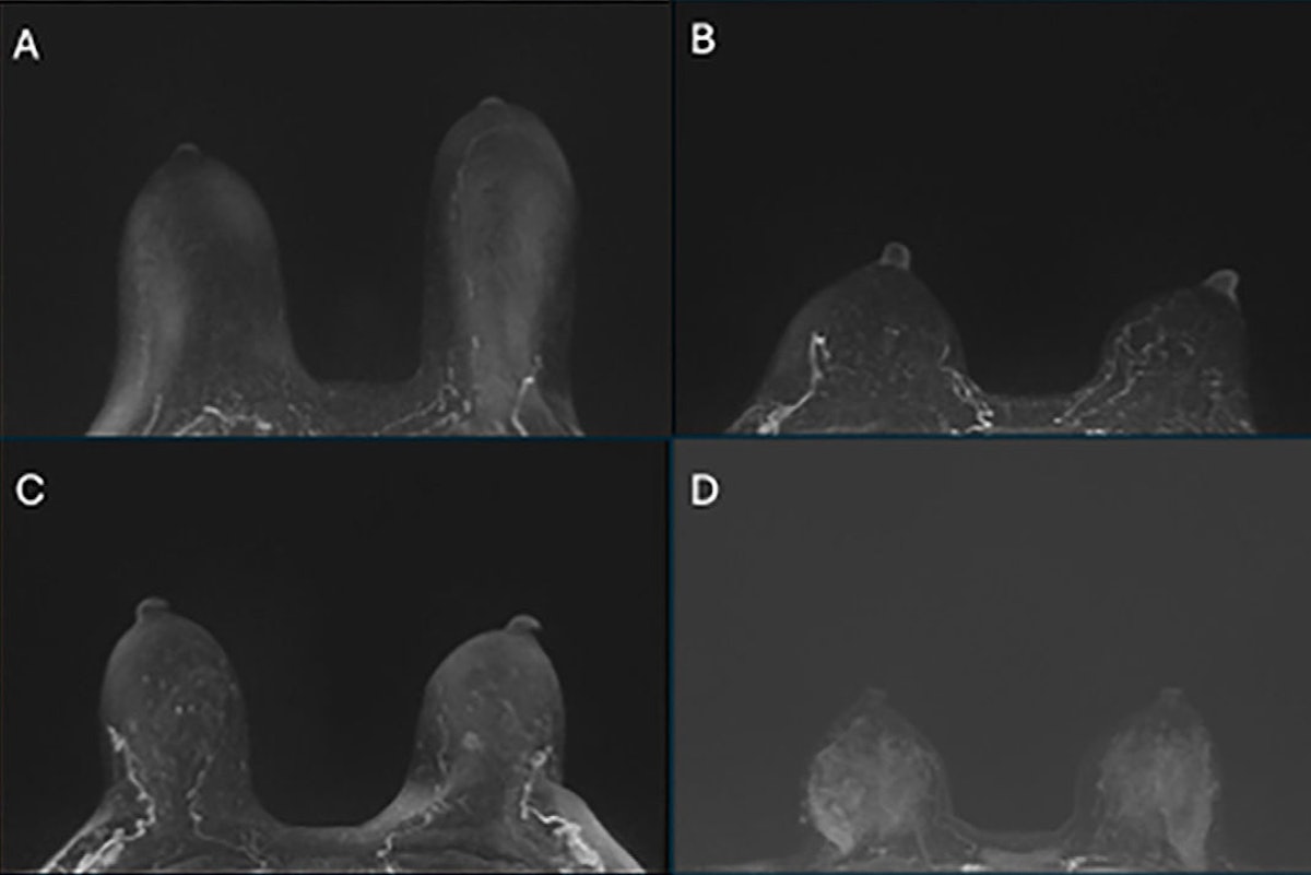 Breast MRI shows higher BPE levels in Black women | AuntMinnie