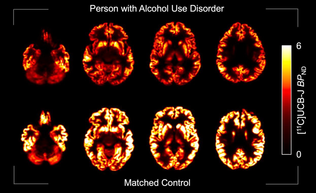 How does high alcohol use affect the brain? | AuntMinnie