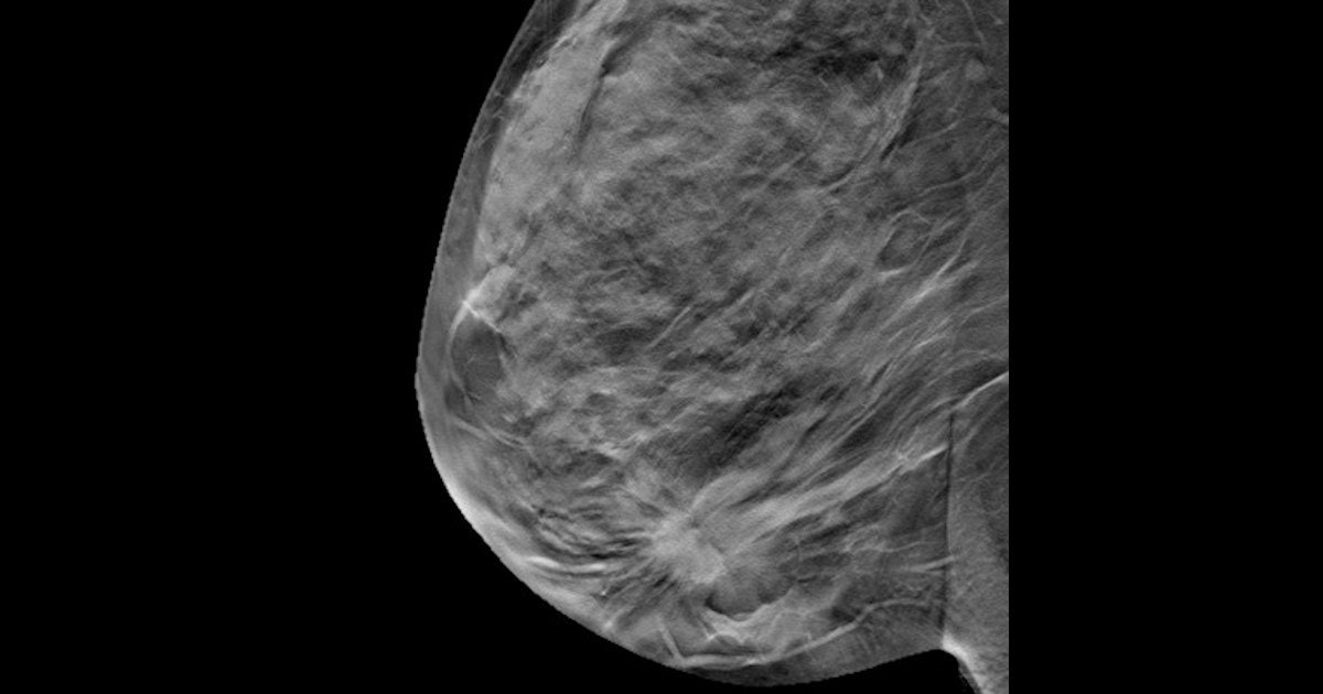DBT's performance suffers when imaging extremely dense breasts | AuntMinnie