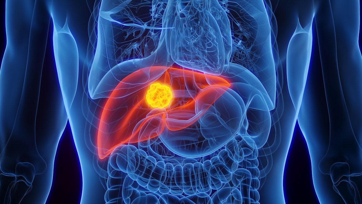 Ablation effective in patients with rare type of liver cancer | AuntMinnie