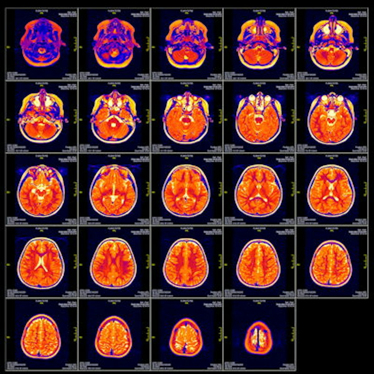 Hyperfine enrolls first patient in contrast study with Swoop system ...