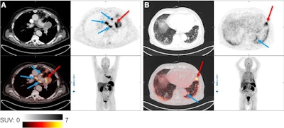 Theranostic pair ready for testing in lung cancer | AuntMinnie