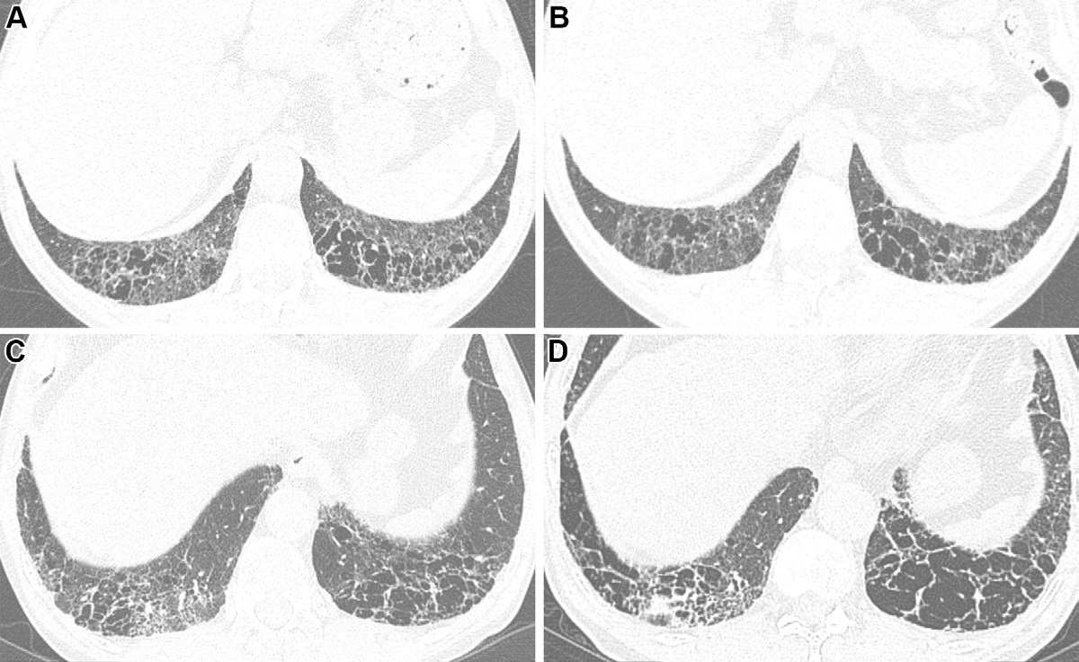 Fibrosis pattern on CT predicts CPFE progression rate, but not survival ...