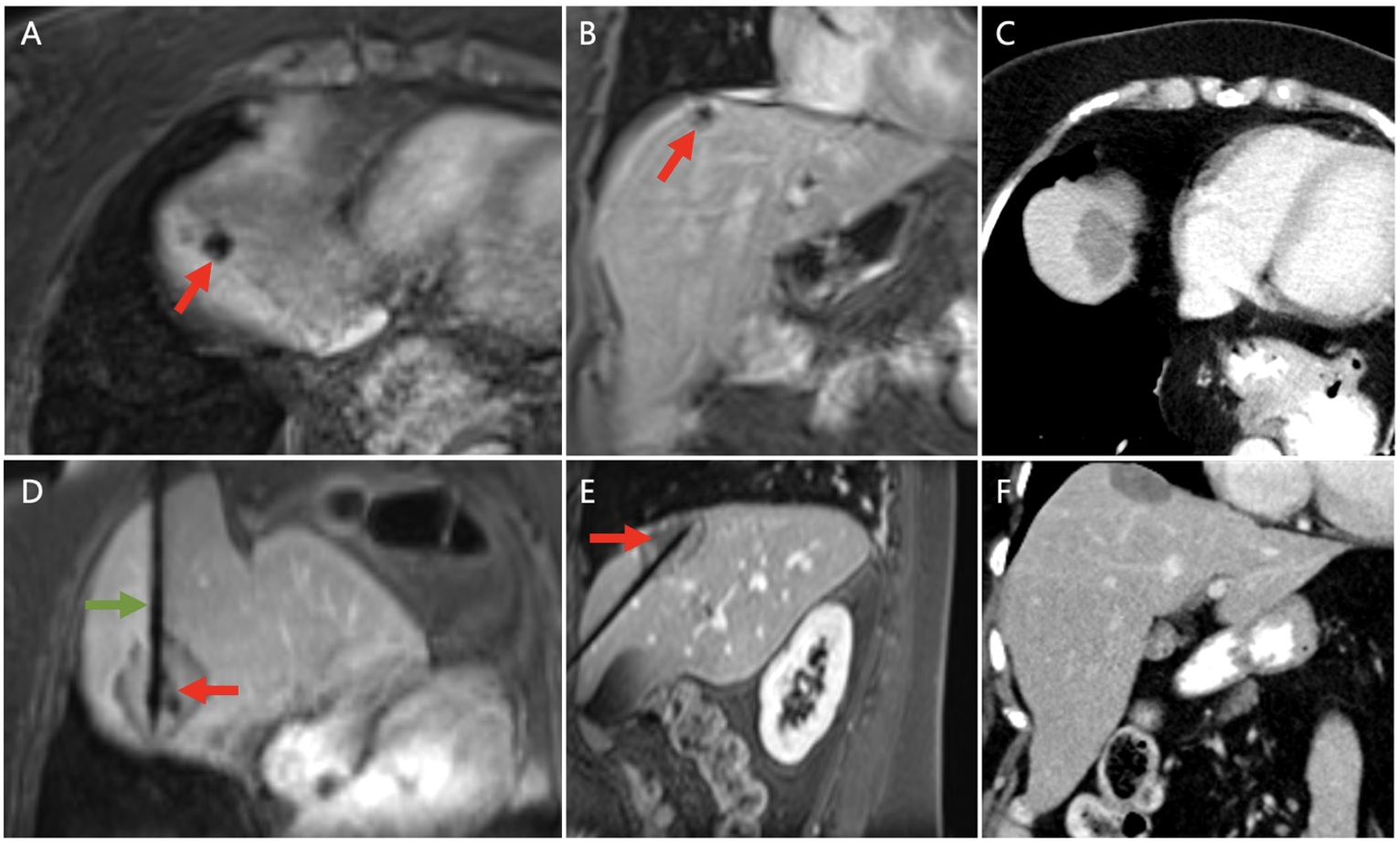 MRI-guided microwave ablation effective for risky liver tumors | AuntMinnie